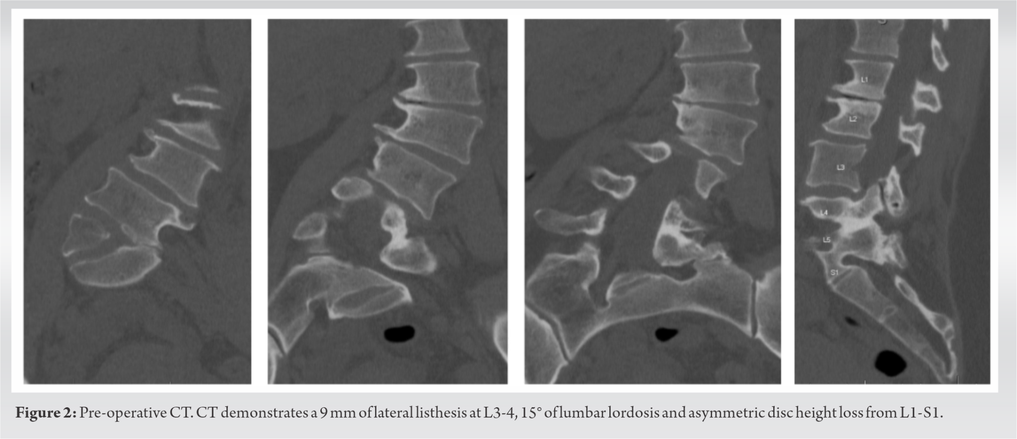 Multilevel Customized 3D-Printed Titanium Alloy Interbody Cages used to ...