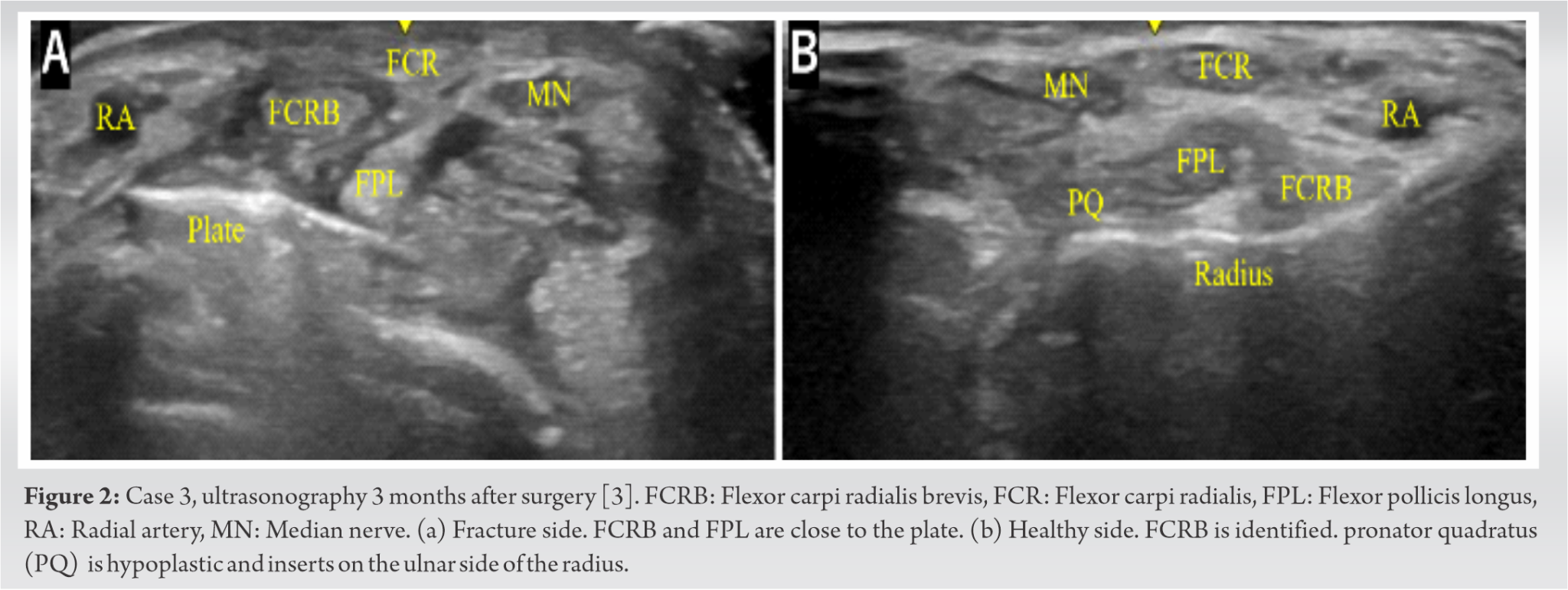 Surgical Treatment of Distal Radius Fractures Complicated by ...