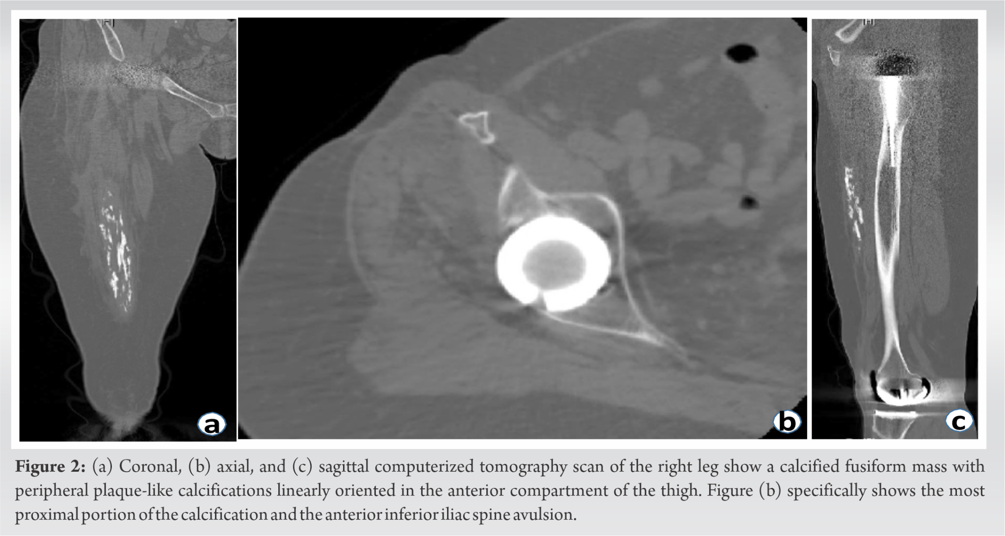 Bilateral Lower Extremity Calcific Myonecrosis: A Case Report | Journal ...
