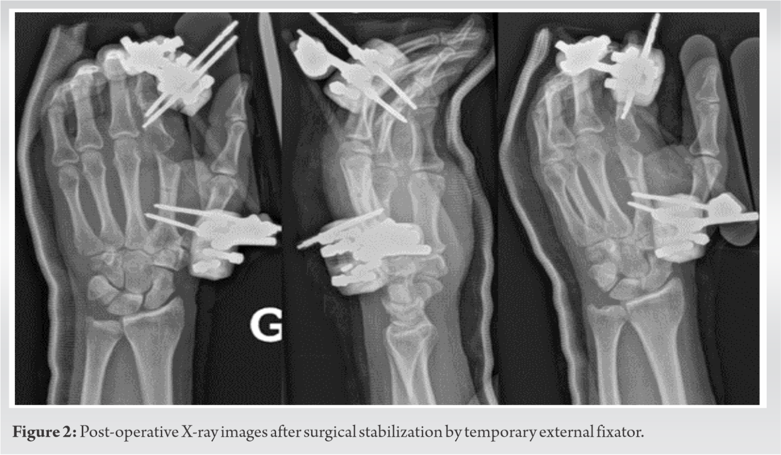 Metacarpal Joint Arthroplasty in the Acute Setting: A Case Report ...