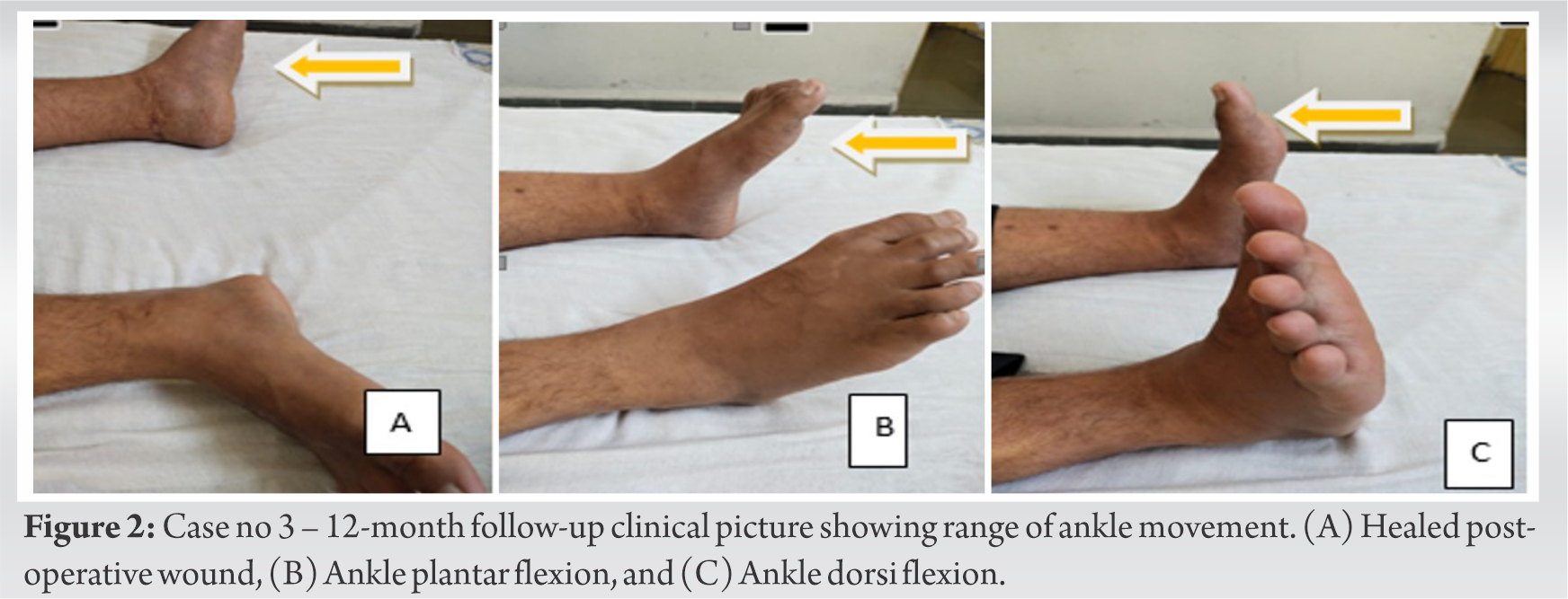 Extruded Fracture Dislocation of Talus, A Rare and Devastating Injury ...