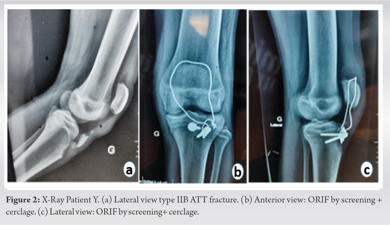 Tibial Tubercle Avulsion Fractures in Adolescence in Sports Injury ...