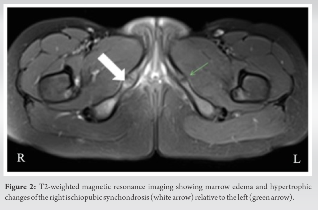 Van Neck-Odelberg Disease: A Rare Cause of Pediatric Hip Pain | Journal ...