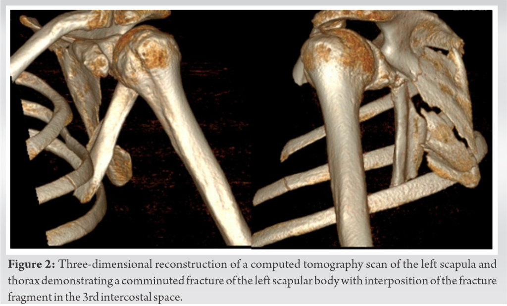 Traumatic Scapula Fracture with Intrathoracic Interposition: A Case ...