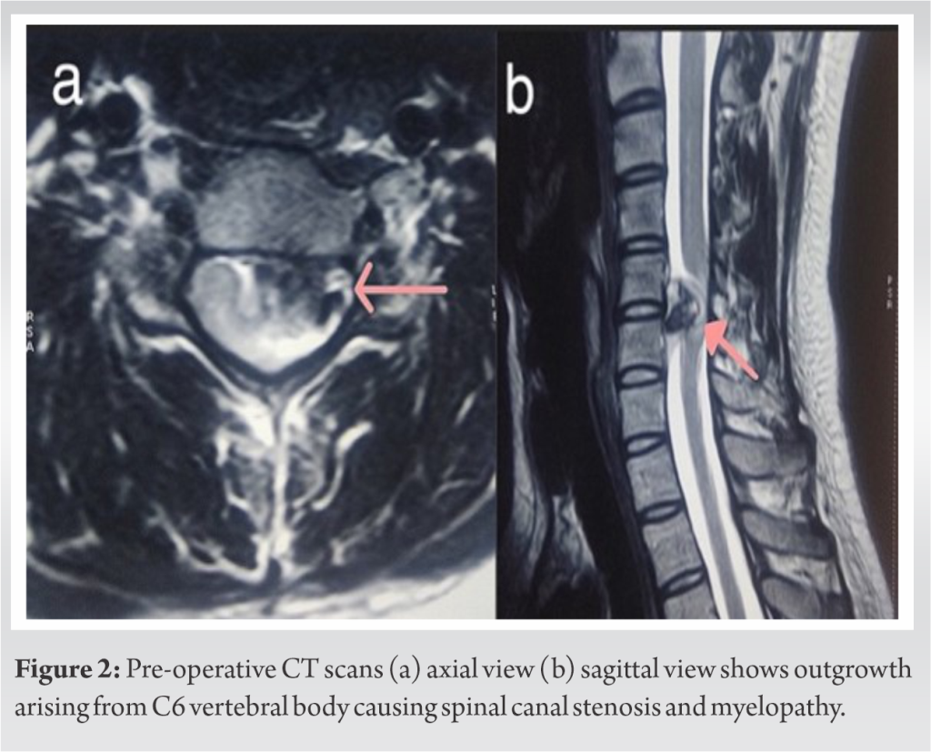 A Unique Presentation of Vertebral Body Osteochondroma of Sixth ...