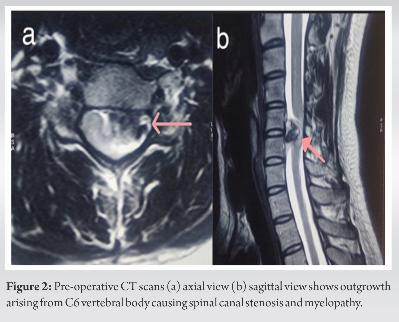 A Unique Presentation of Vertebral Body Osteochondroma of Sixth ...