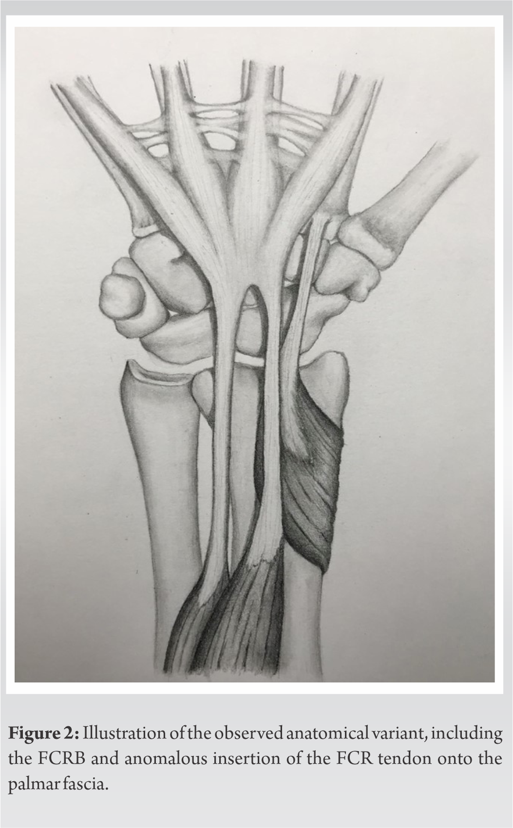 Anomalous Flexor Carpi Radialis Tendons Giving Rise to a Novel Surgical ...