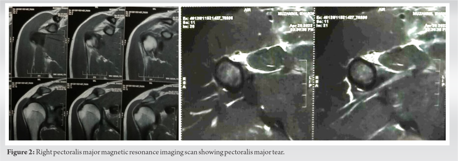 Rupture of Pectoralis Major Muscle: A Case Report | Journal of ...