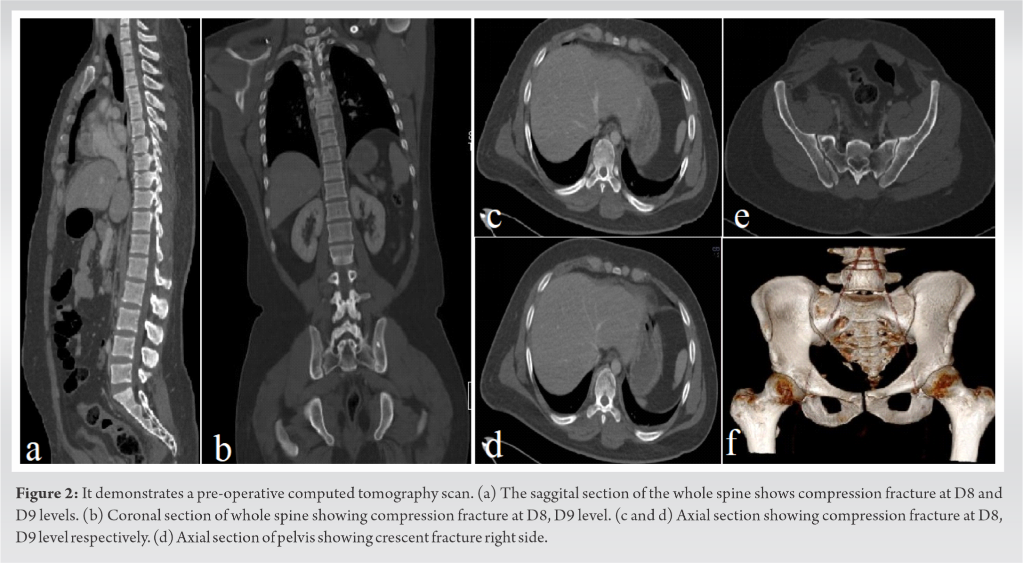 Unilateral Traumatic Testicular Dislocation in a Patient of Pelvic ...