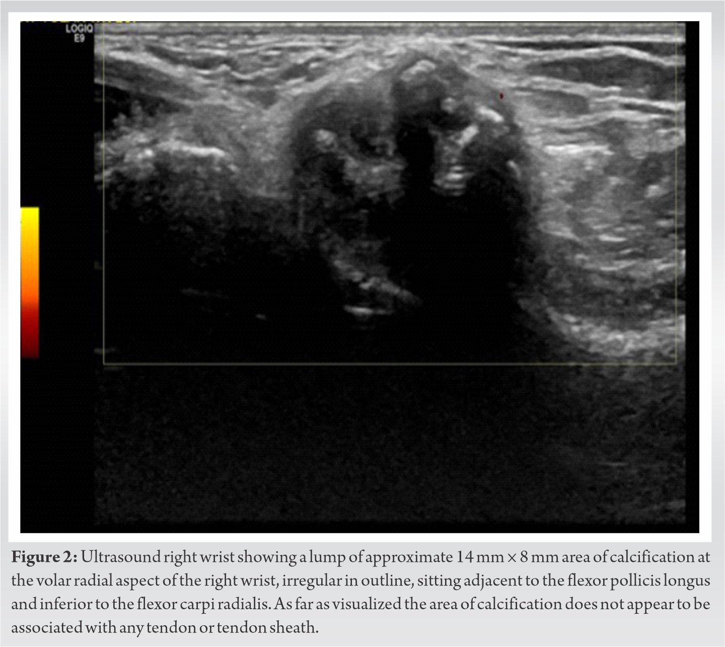 Uncommon Expression of Osteochondroma in the Wrist: A Case Report ...