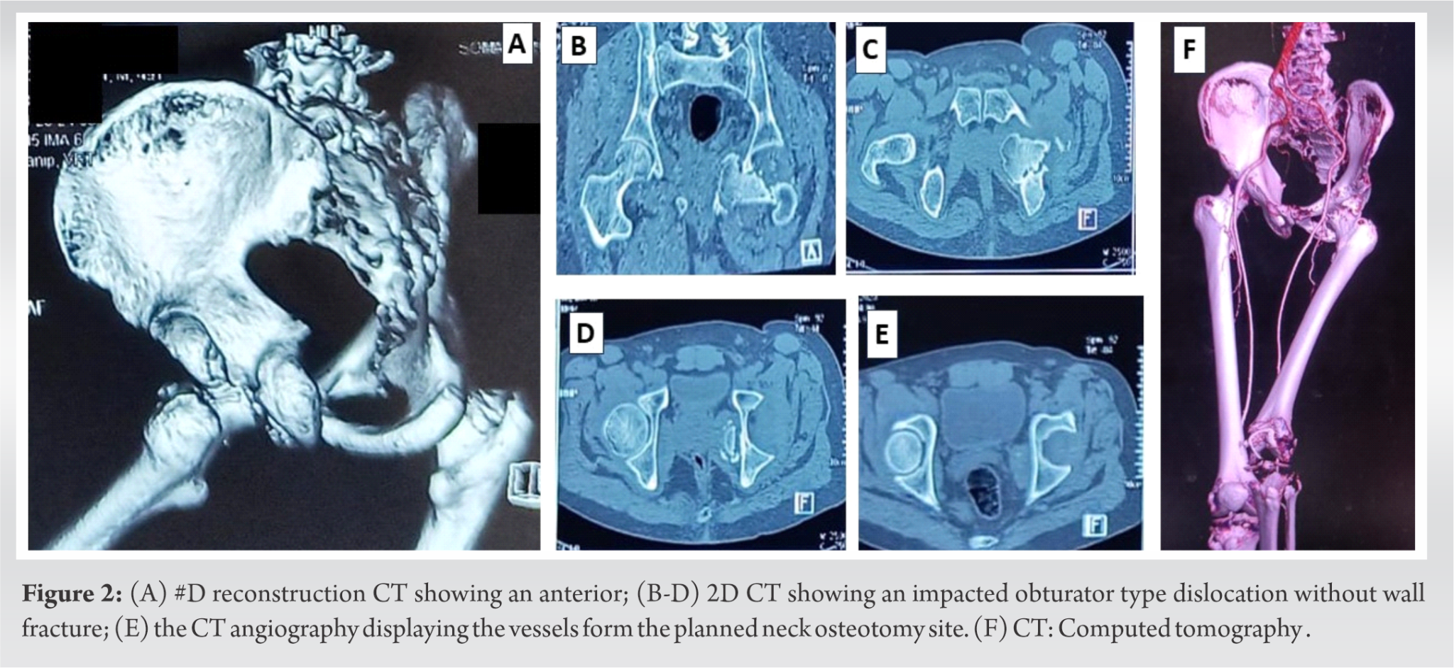 Neglected Anterior Dislocation of Hip Managed with Total Hip ...