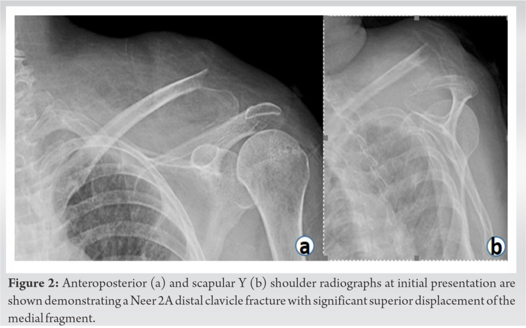 A 65-Year-Old Female with Missed Open Clavicle Fracture and Subsequent ...