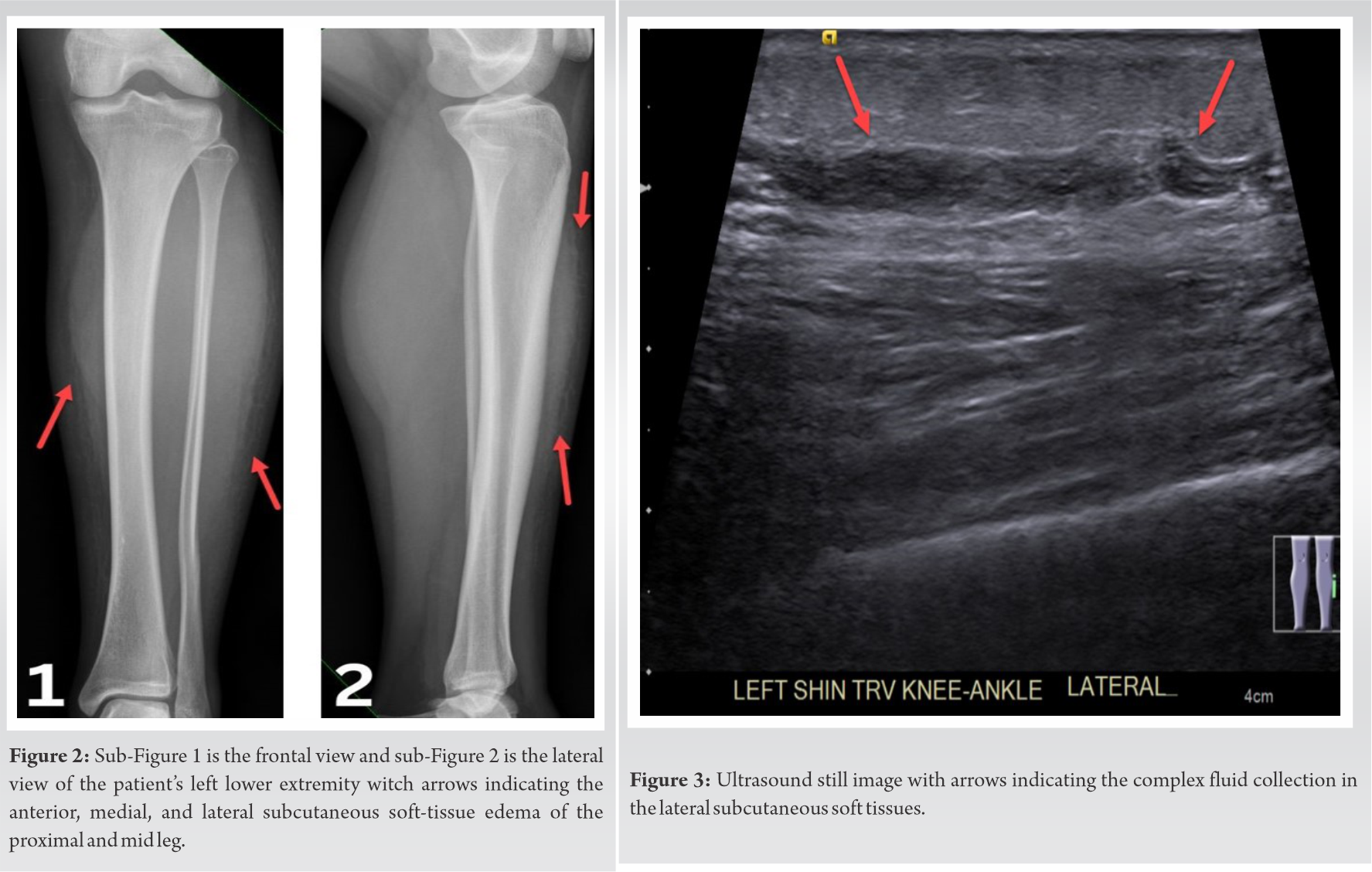 Delayed Onset of Pediatric Morel-Lavallée Lesion: A Case Report ...