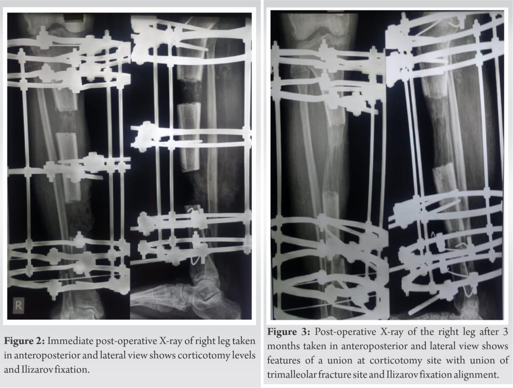 A Case of “Nonunion Distal Tibia and Fibula Malleoli Fracture with ...