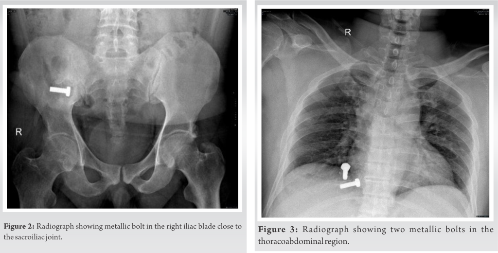 Decade Later Presentation of an Intraosseous Metallic Foreign Body in ...