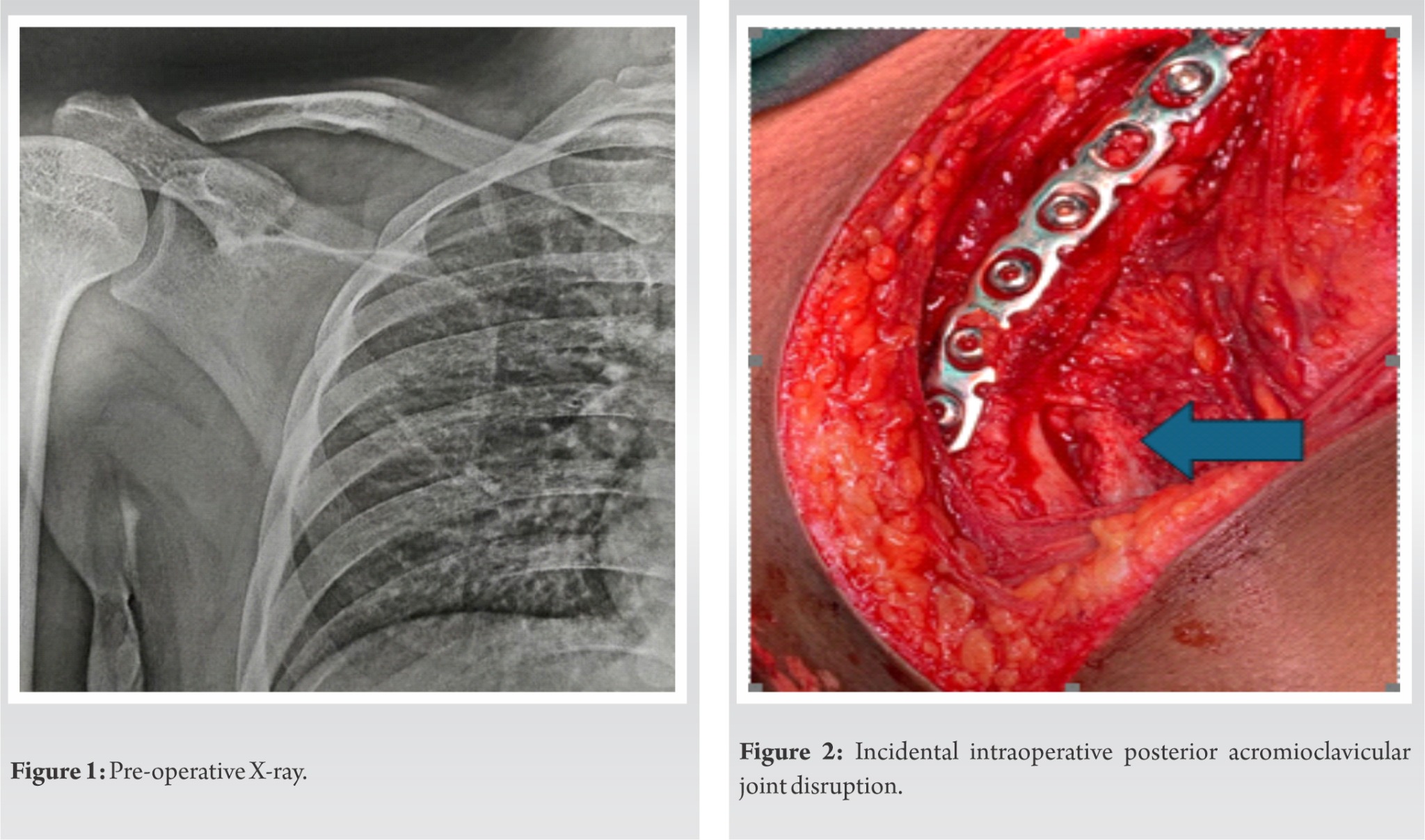 Mid-shaft Clavicle Fracture with Disguised Ipsilateral Type IV ...