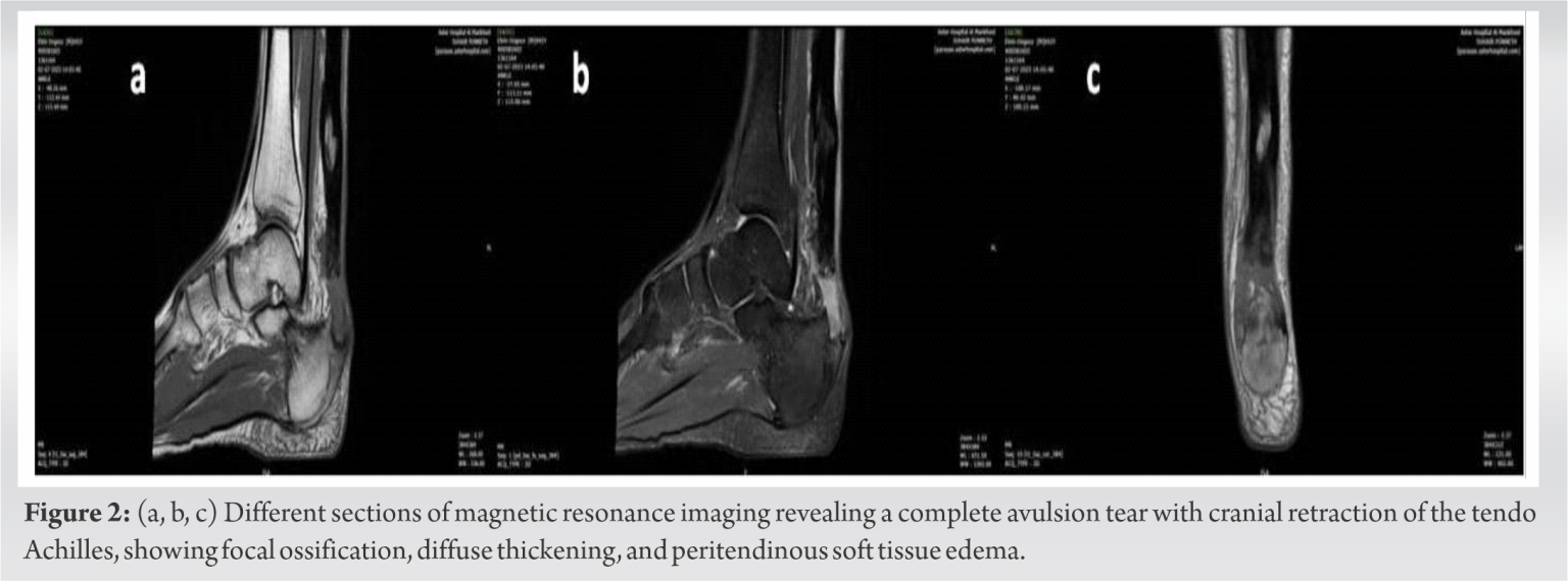 Heterotopic Ossification of the Achilles Tendon in a Patient with Type ...
