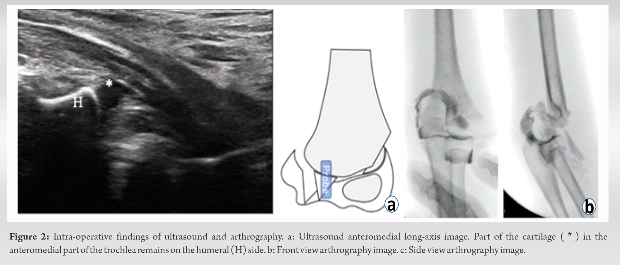Case report: triplane fracture of distal humeral epiphysis diagnosed ...
