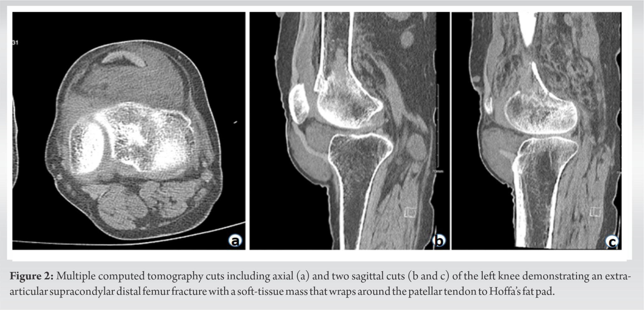 Intra-articular Knee Neurofibroma in a Patient with Neurofibromatosis ...
