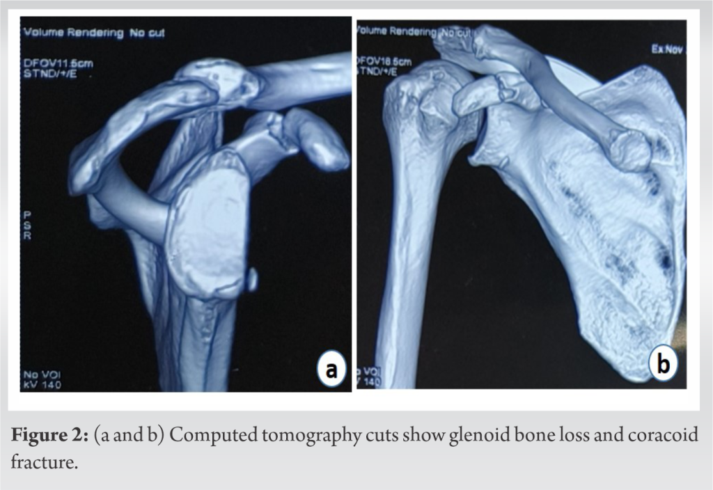 Recurrent Anterior Shoulder Dislocation with Coracoid Fracture in an ...