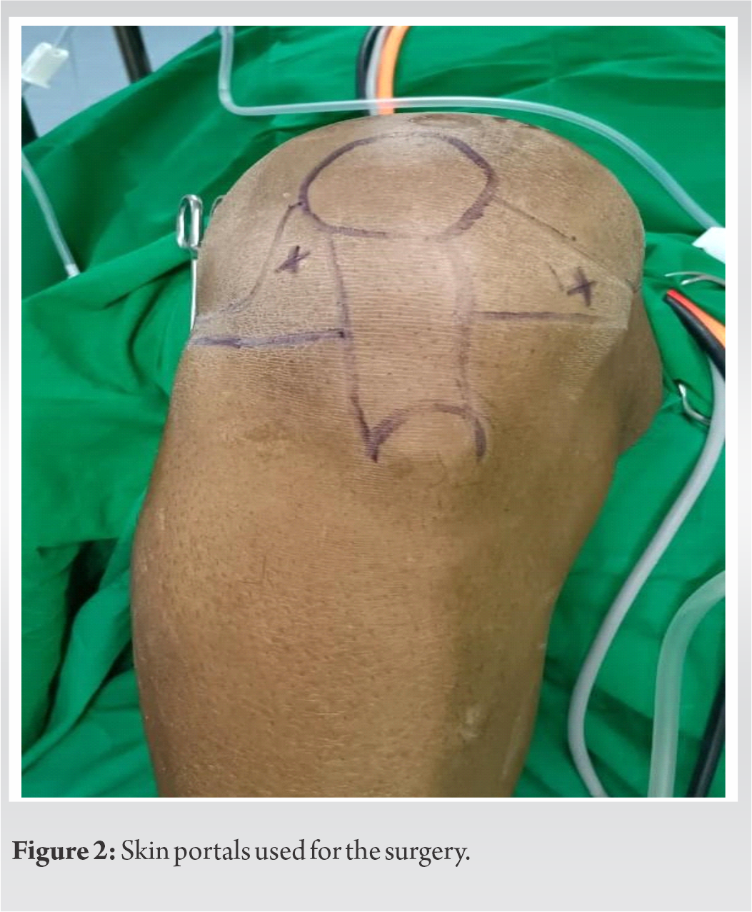 ACL Femur Cyst Very Rare Presentation – A Case Report | Journal of ...