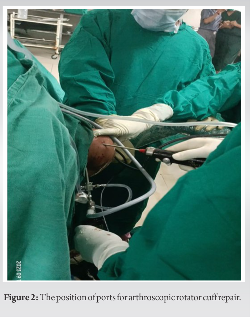 Shoulder Surgeries under Regional Anesthesia Approach and Outcome – A ...