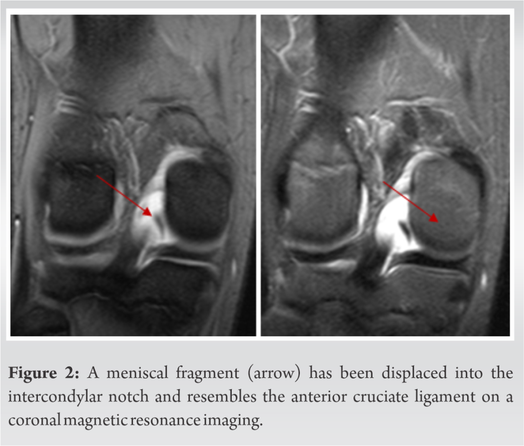 Flag Sign: A Case Report of an Unusual Magnetic Resonance Imaging ...