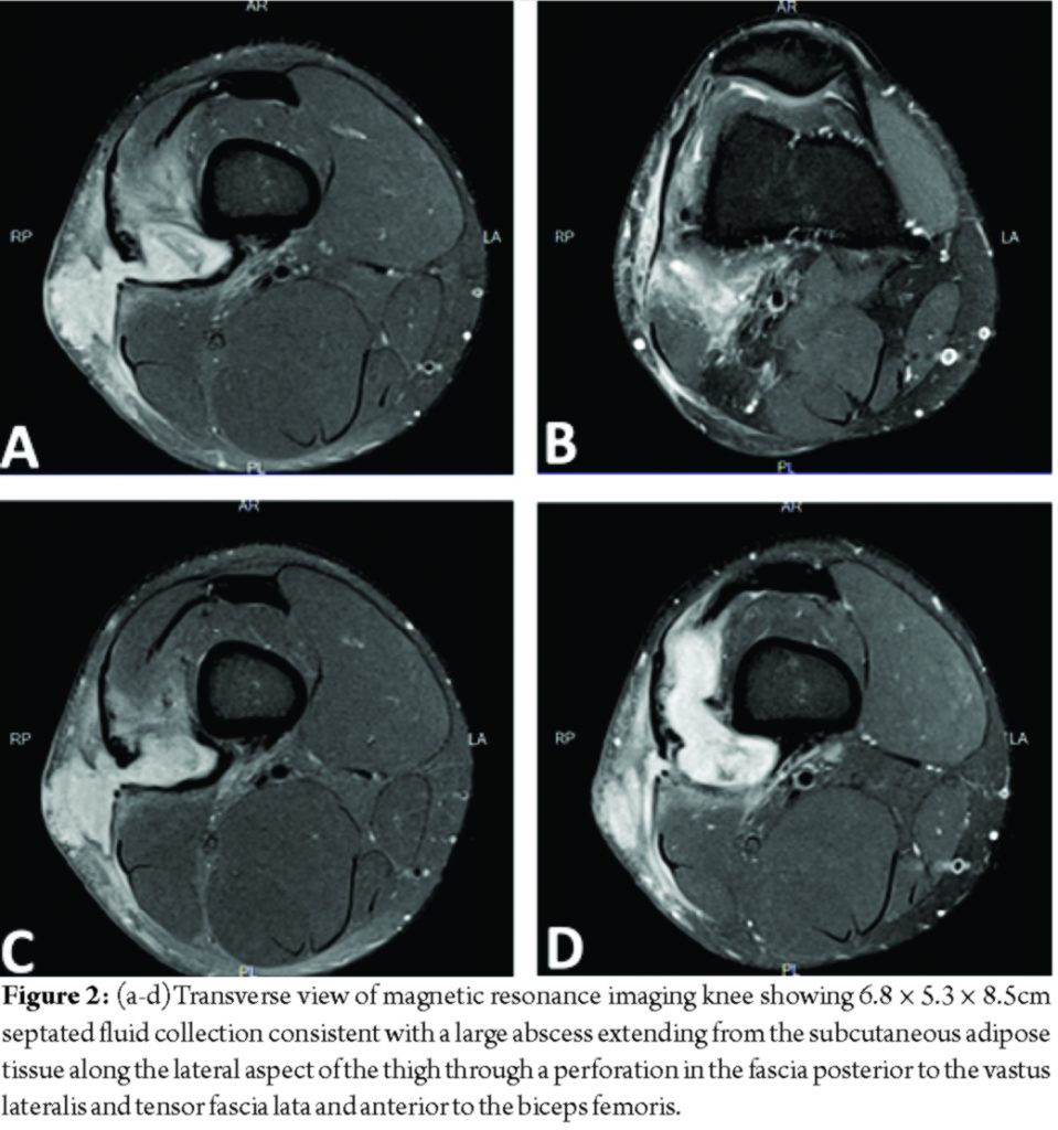 Challenges in the Diagnosis of Brodie’s Abscess in Subacute ...