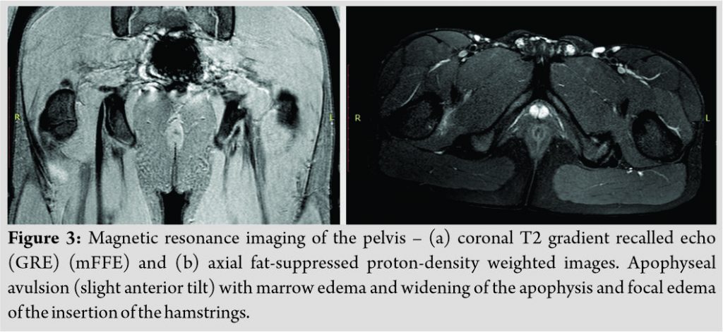 Apophysitis of the Ischial Tuberosity: A Case Report | Journal of ...