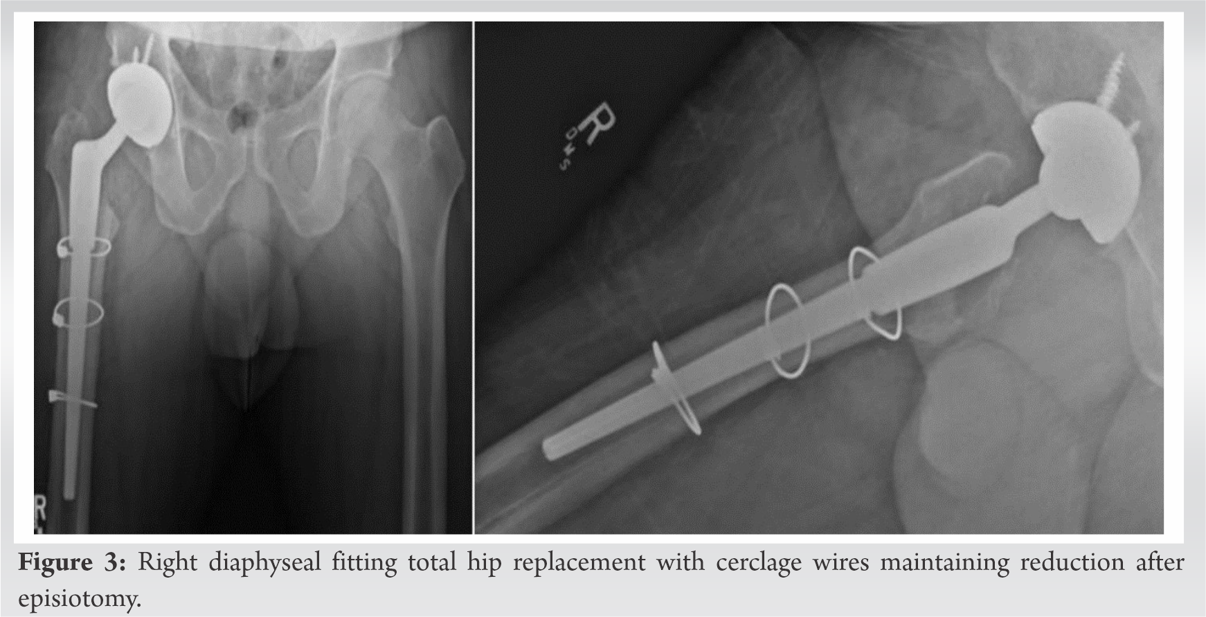 Episiotomy-assisted Incarcerated Femoral Nail Removal: Technical Note ...