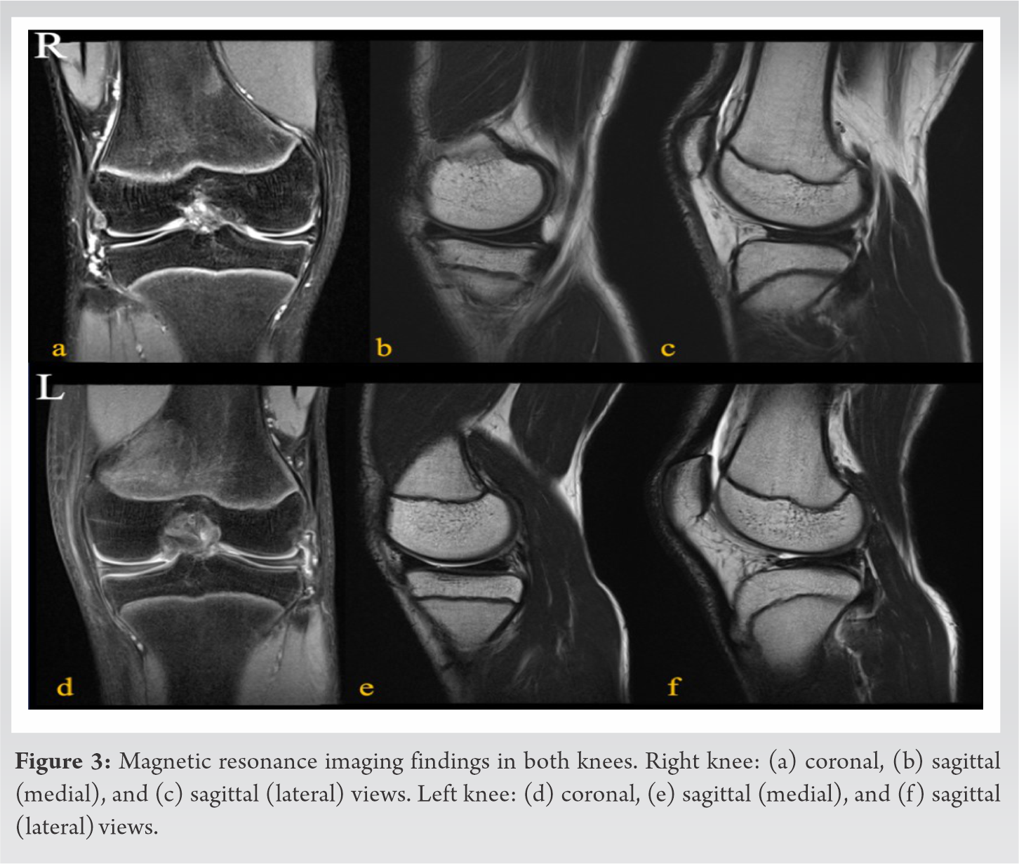 Bilateral Medial and Lateral Discoid Menisci: A Case Report | Journal ...