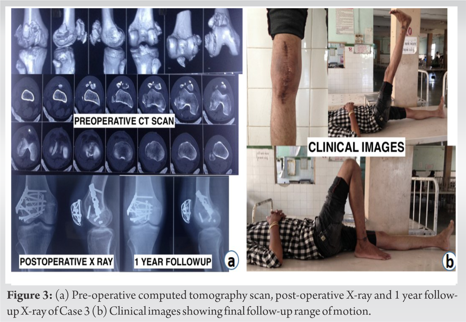 Management of Rare Open Patella Sagittal Plane Fracture with Associated ...
