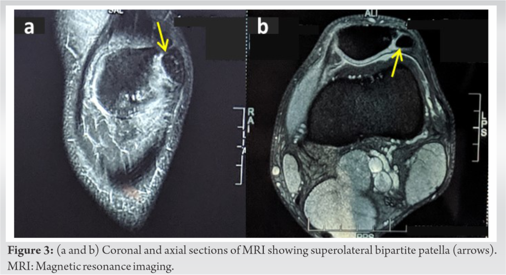 Bipartite Patella in an Elite Football Player – A Rare Cause of ...