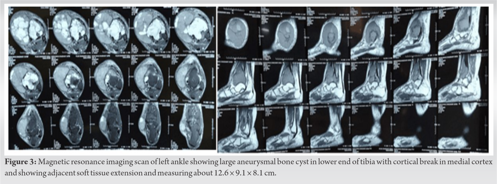 A Case Report of Giant Aneurysmal Bone Cyst of Distal Tibia with a Non ...