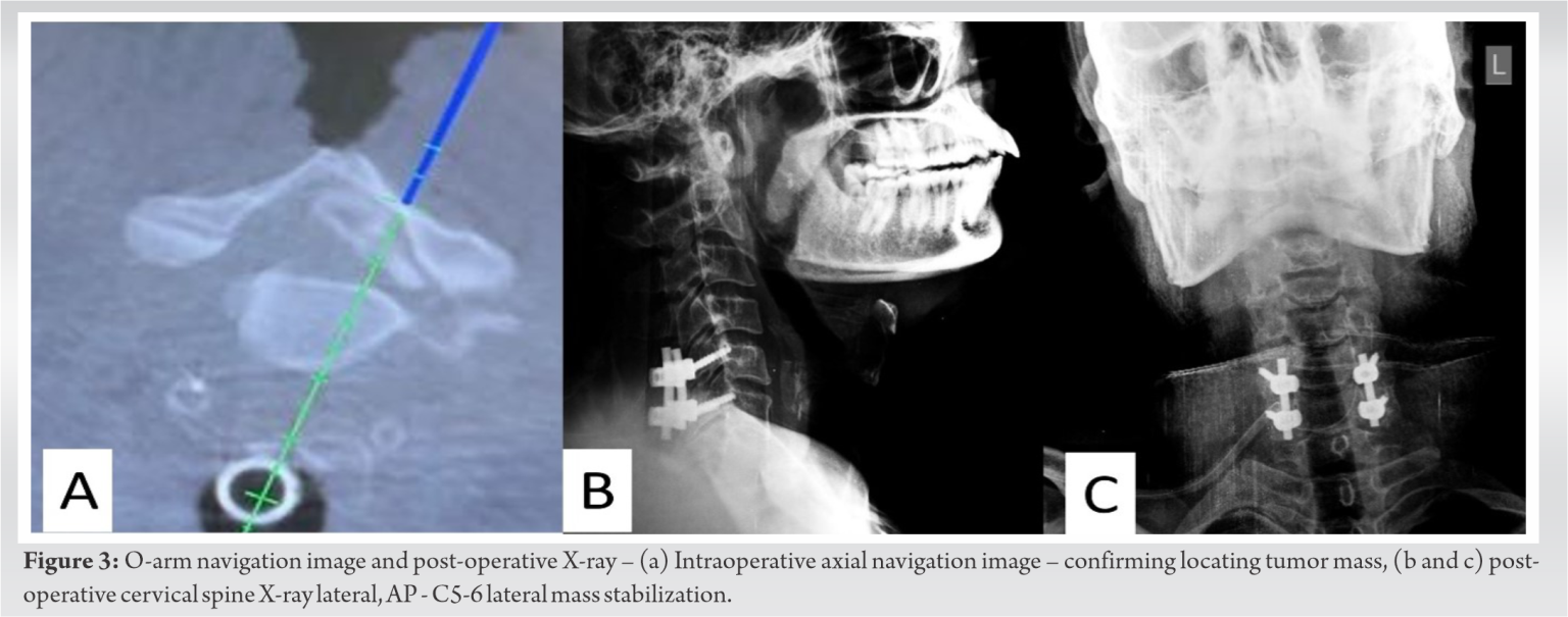 O-arm Navigated en bloc Excision of a Solitary Subaxial Cervical ...