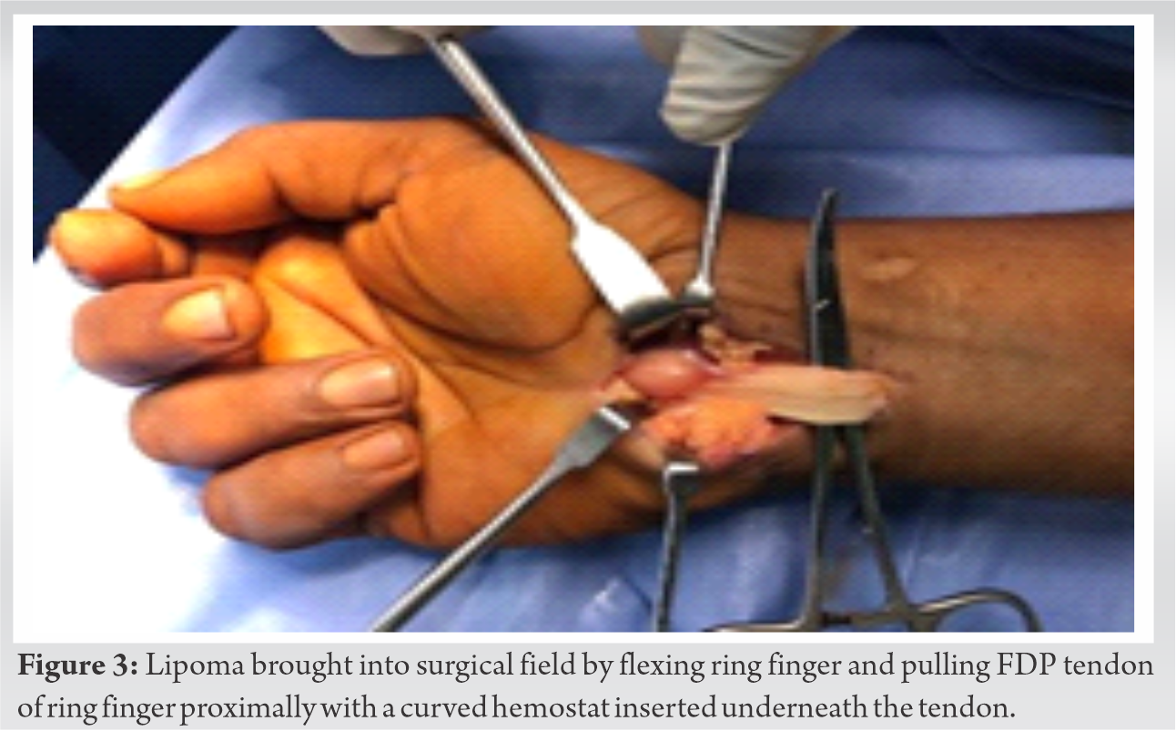 Fibrolipoma of Flexor Digitorum Profundus Tendon of Ring Finger Causing ...