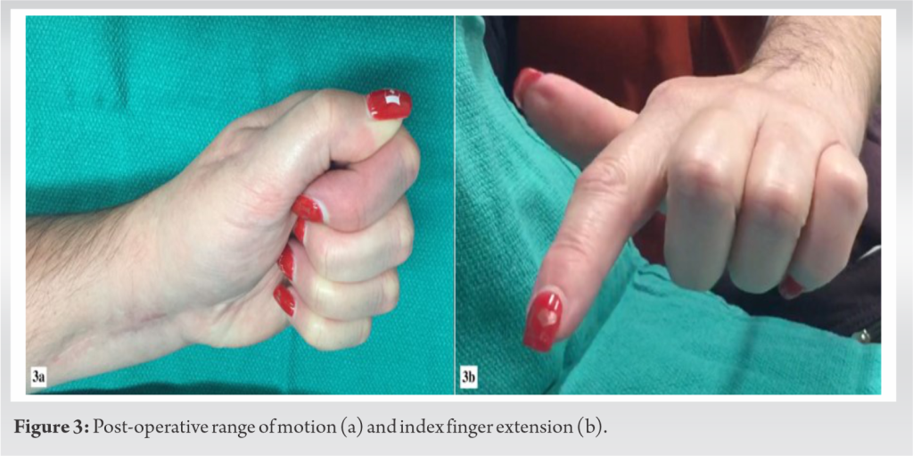 Concomitant Extensor Pollicis Longus and Extensor Digitorum Longus ...