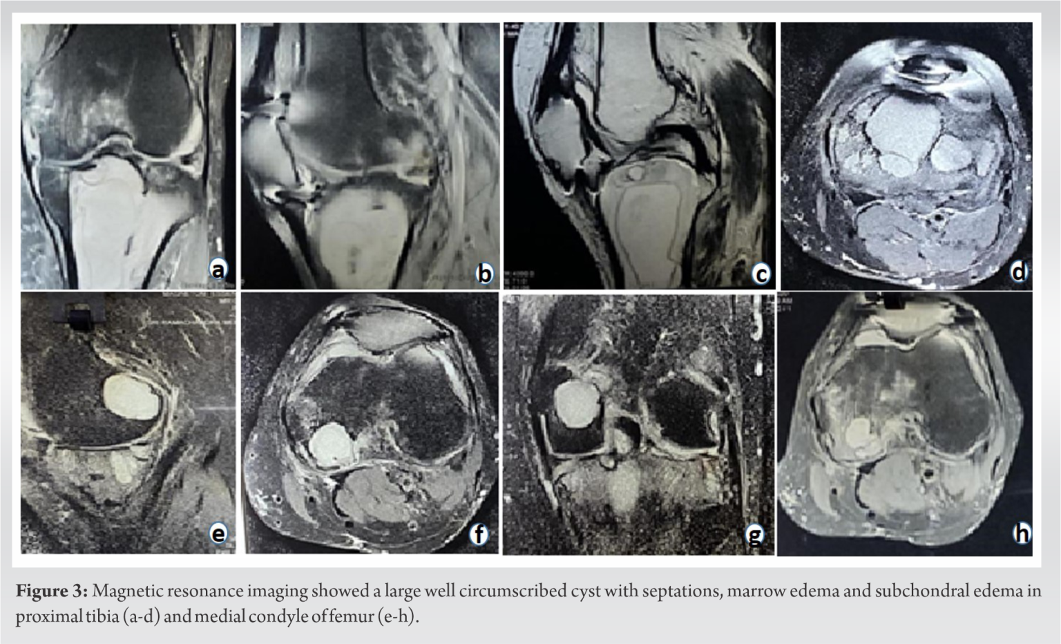 A Massive Proximal Tibia Geode – Can we Afford to Miss it? | Journal of ...