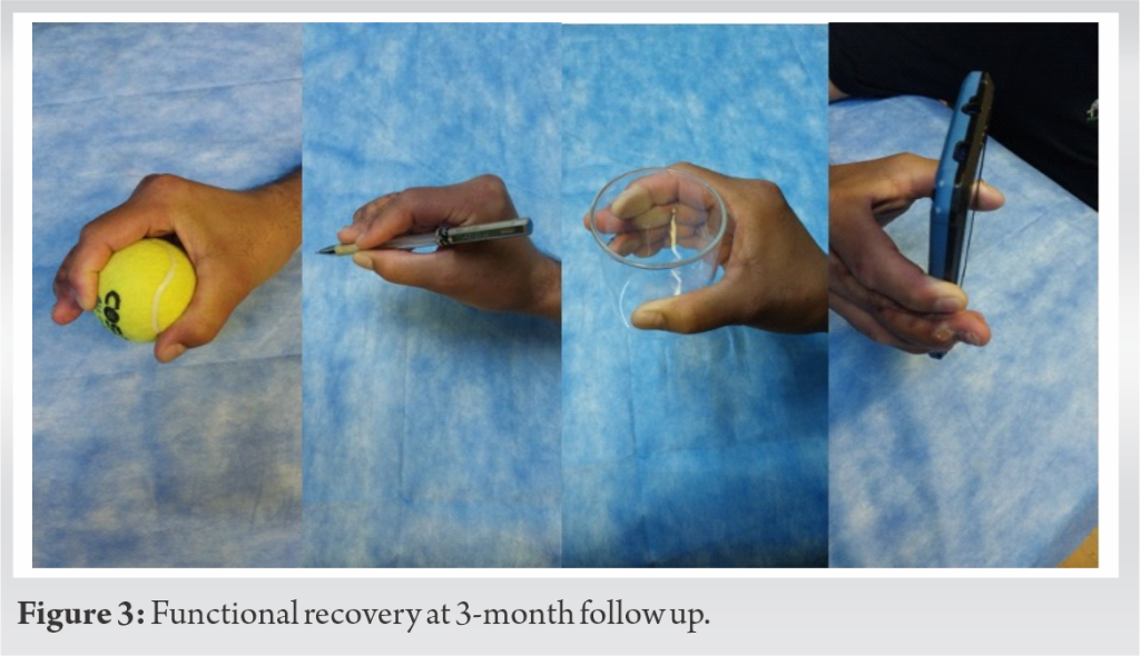 Management of Soft-tissue Defects of Hand in a Conflict Combat Zone: A ...