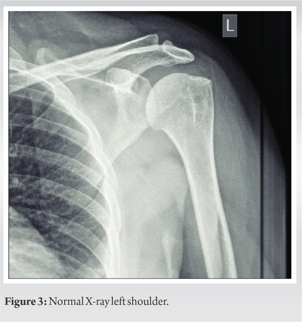 Decompression of Paralabral Cyst near Axillary Nerve: A Case Report ...