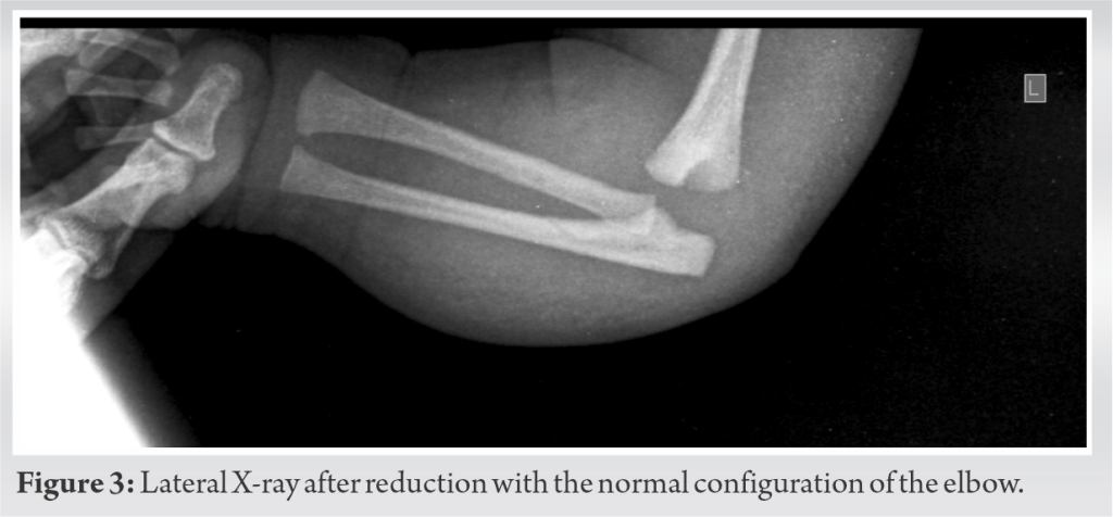 Neonatal Transphyseal Separation of the Distal Humeral Epiphysis: Early ...