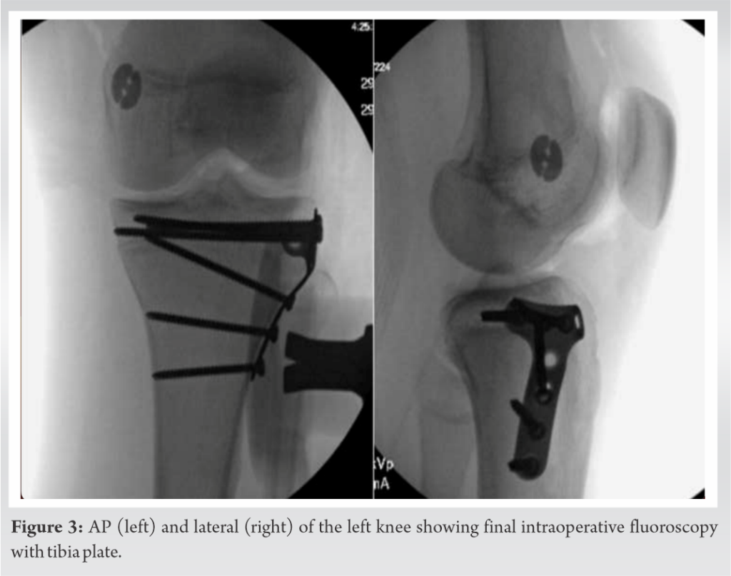 Combined Lateral Plateau and PCL Injury in a Pediatric Patient: A Case ...