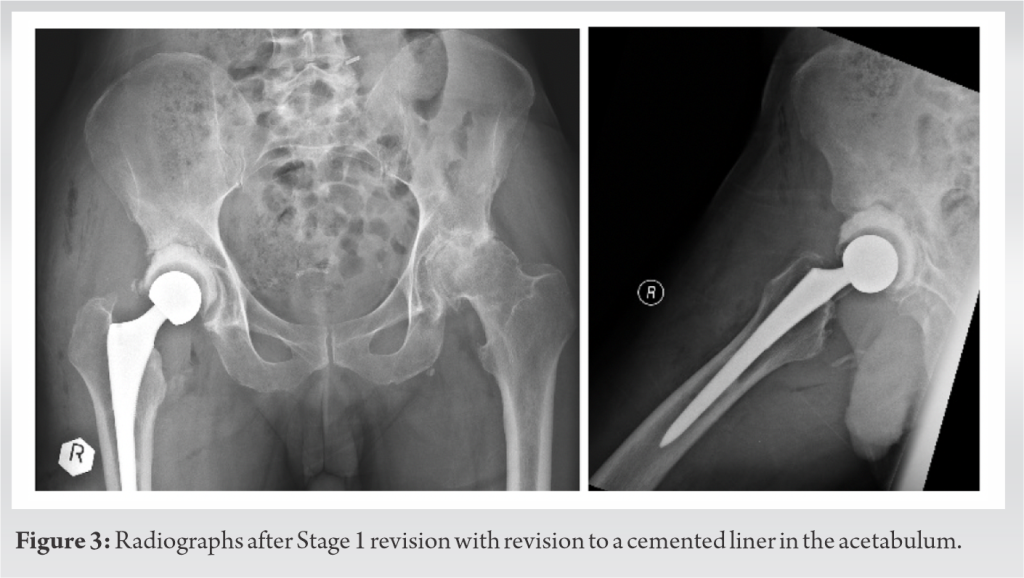Two-stage Partial Component Retention and Interim Cemented Liner for ...