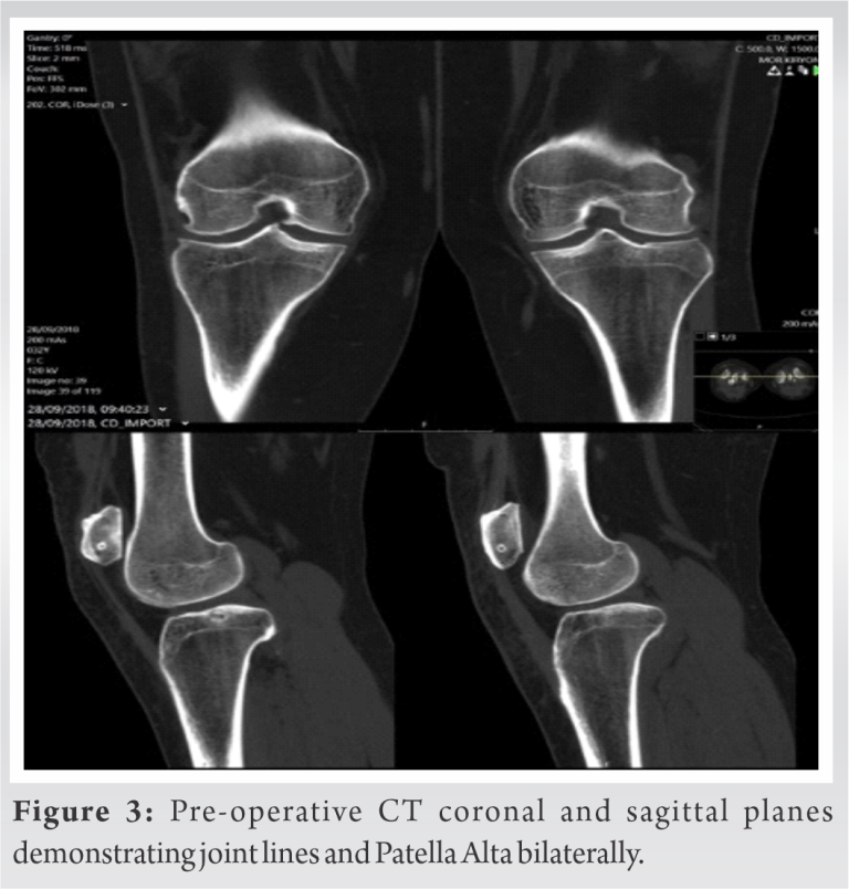 Patellofemoral Arthroplasty for Irreducible Chronic Bilateral Patella ...