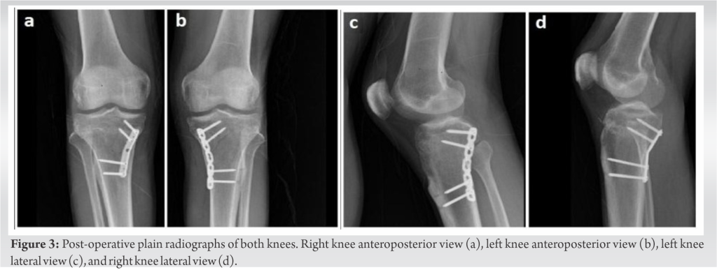 Low-Energy Trauma-Induced Bilateral Isolated Posteromedial Tibial ...