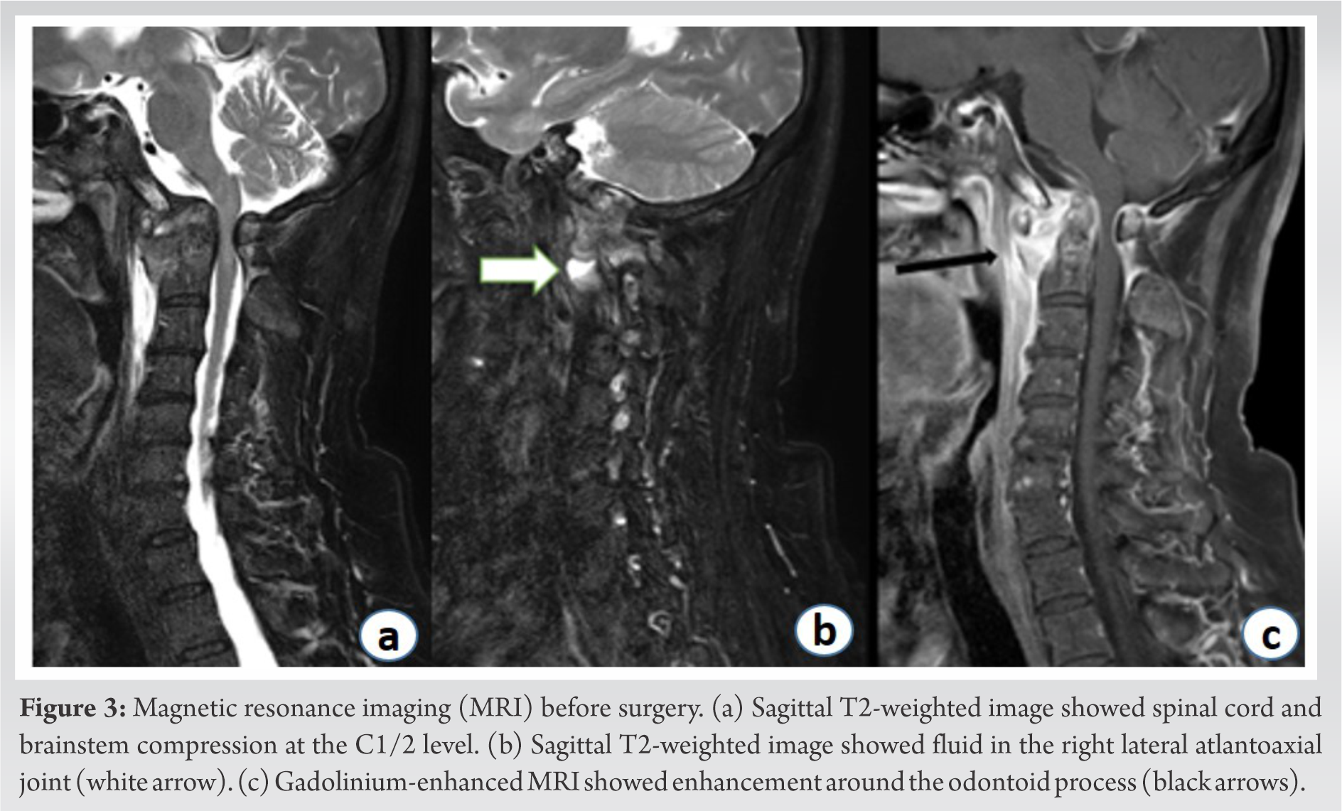 Vertical Subluxation Caused by Infection Around the Odontoid Process: A ...