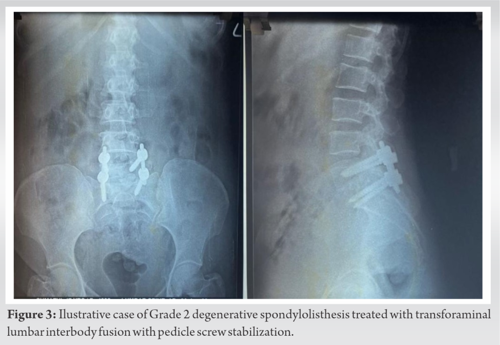 The Functional Outcome of Surgical Management of Spondylolisthesis with ...