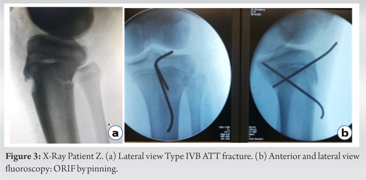 Tibial Tubercle Avulsion Fractures in Adolescence in Sports Injury ...