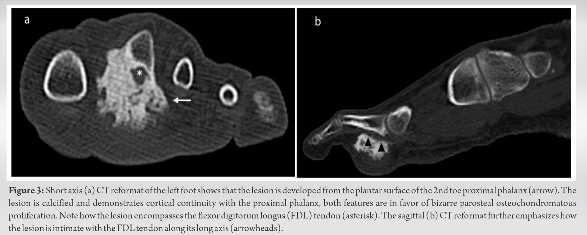 Bizarre Parosteal Osteochondromatous Proliferation (Nora’s Lesion) Of ...