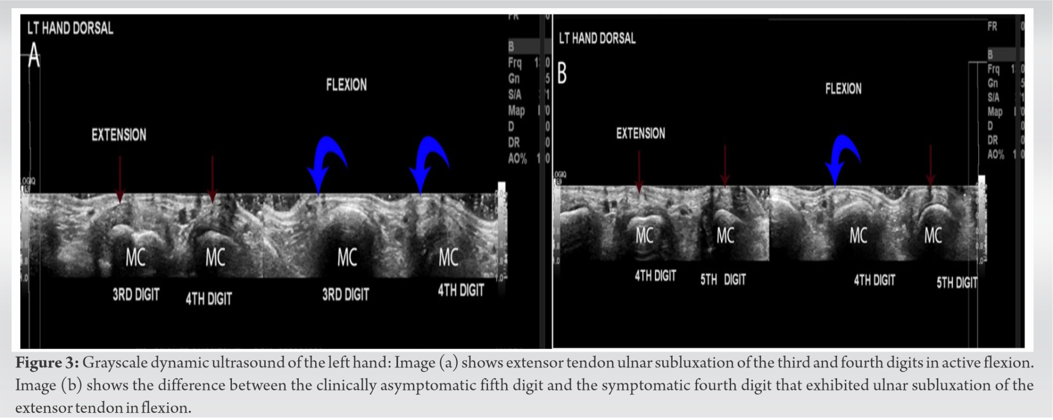 Spontaneous Idiopathic Bilateral Sagittal Band Rupture: A Case Report ...